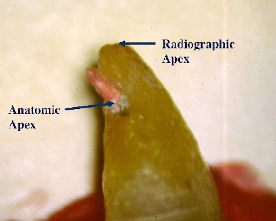 Root canal treatment: Where does the apex end? | Dentistry IQ