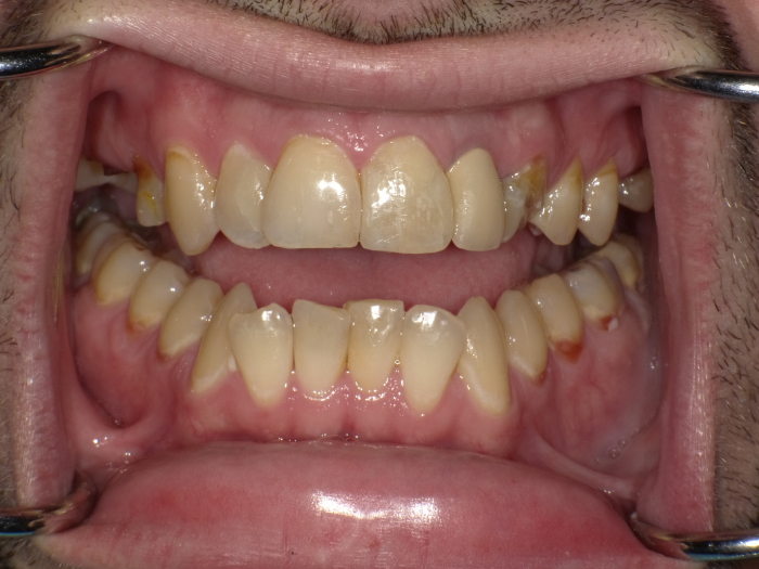 Heroin Effects On Teeth