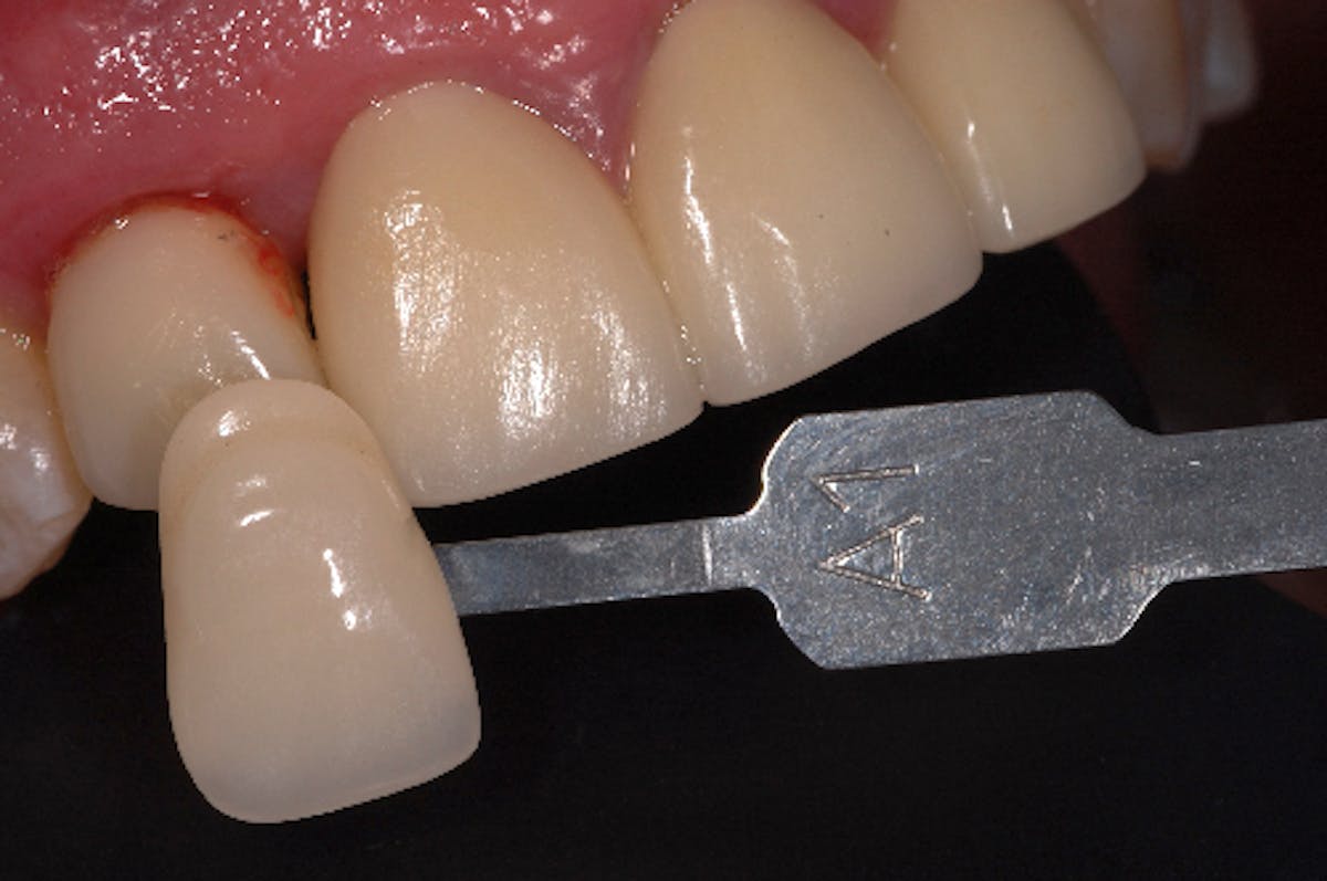 Cross-polarized reflective light dental photography: The silver bullet ...
