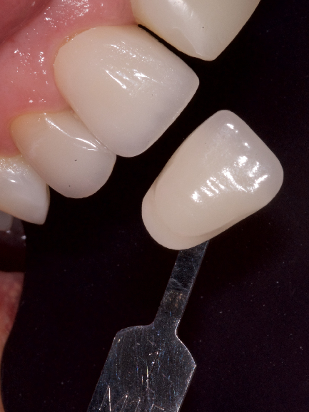 Cross-polarized reflective light dental photography: The silver bullet ...