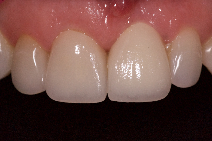 Cross-polarized reflective light dental photography: The silver bullet ...