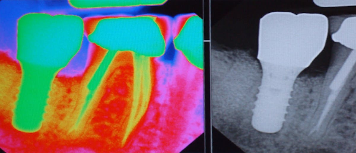 Dental implant care basics: Single-tooth replacement | Dentistry IQ