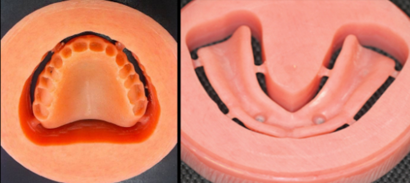 Don't be afraid of dentures: New technology simplifies denture ...