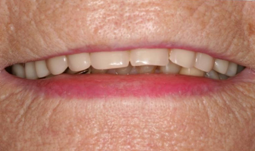 Don't be afraid of dentures: New technology simplifies denture ...