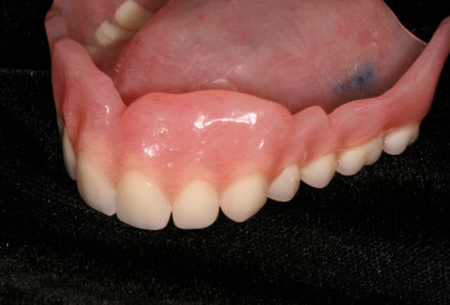 Don't be afraid of dentures: New technology simplifies denture ...