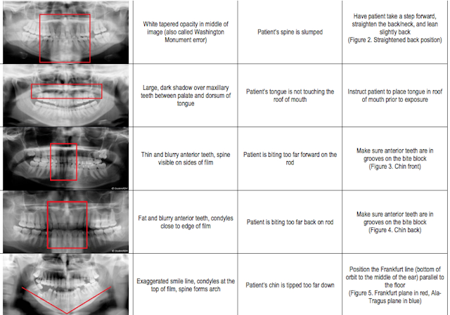 Extraoral panoramic errors: a summary for dental assistants | DentistryIQ