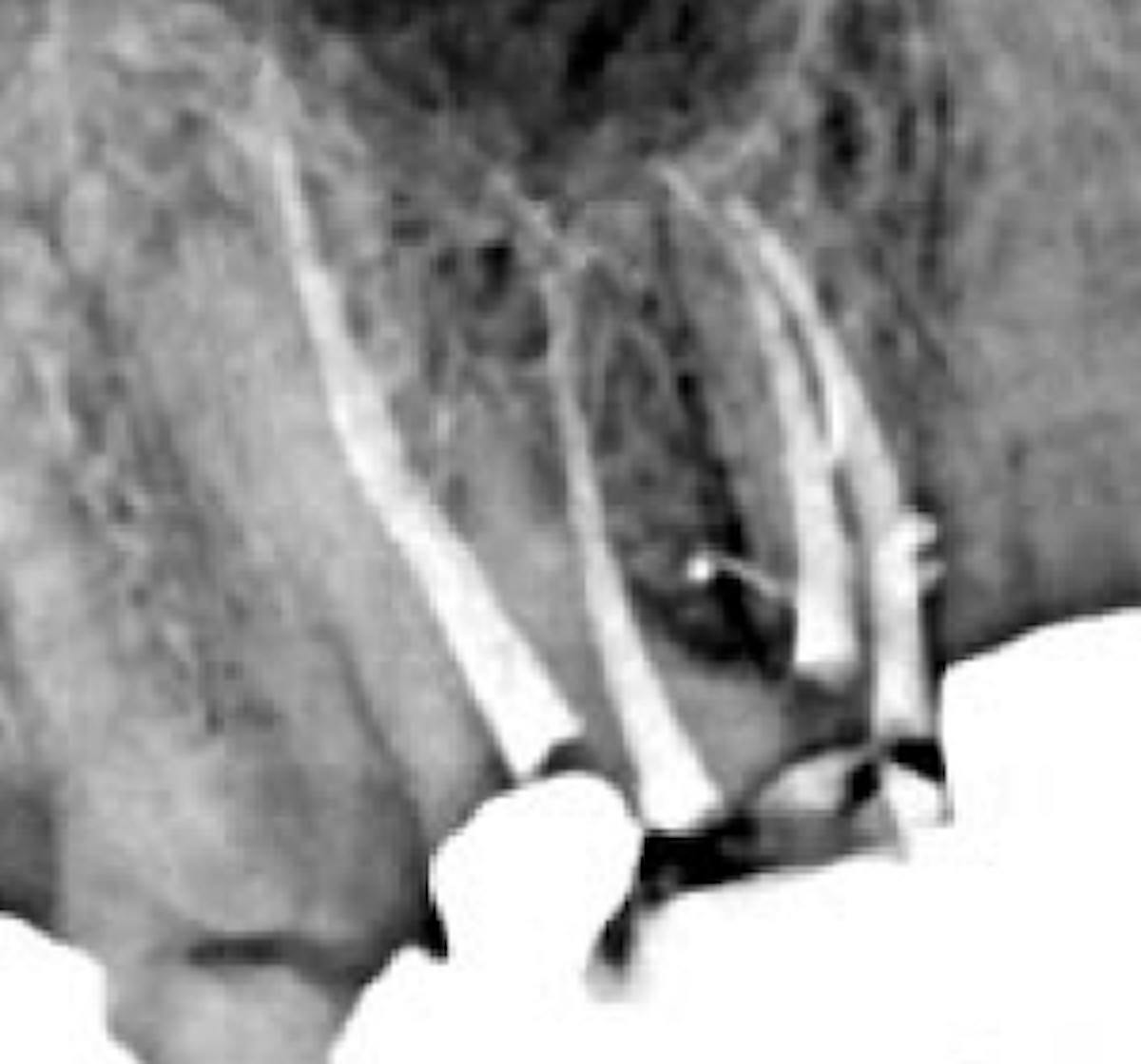 How to obturate like an endodontist | Dentistry IQ