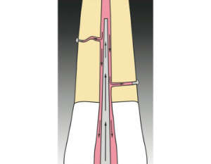 How to obturate like an endodontist | Dentistry IQ