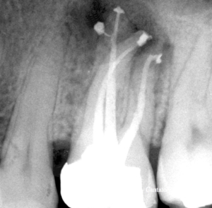 How to obturate like an endodontist | Dentistry IQ