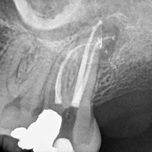 How to obturate like an endodontist | Dentistry IQ
