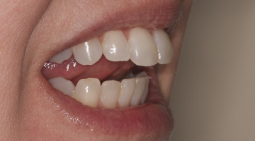 Implants aren't for everyone, and yes, I'd like to obturate like an ...