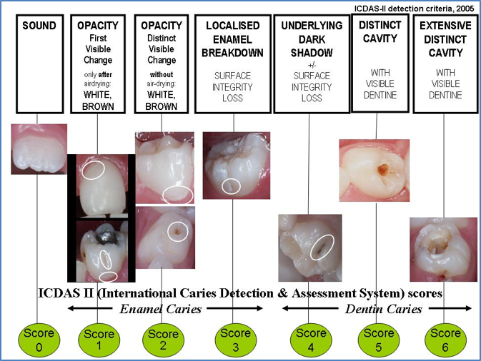 Icdas Caries Classification Classification Based On Caries Depth.