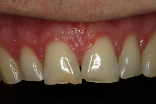 How to treat dental patients who don't know they have occlusal ...