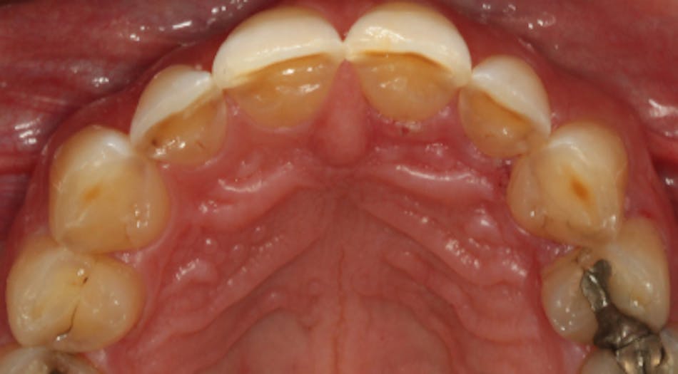 How to treat dental patients who don't know they have occlusal ...