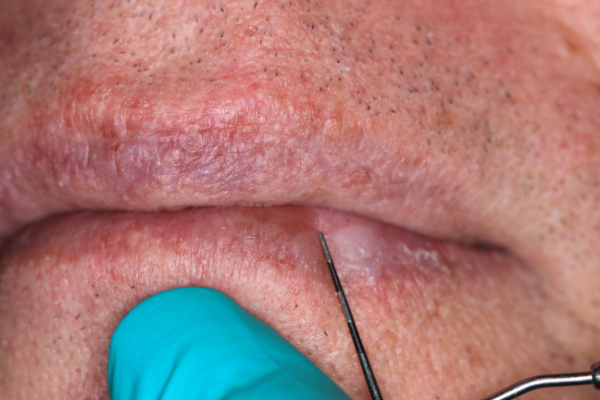 Diagnosis for BC oral pathology case No. 38: The 'harmless-looking ...