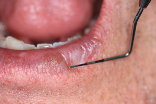 White Patches On Lips Pictures