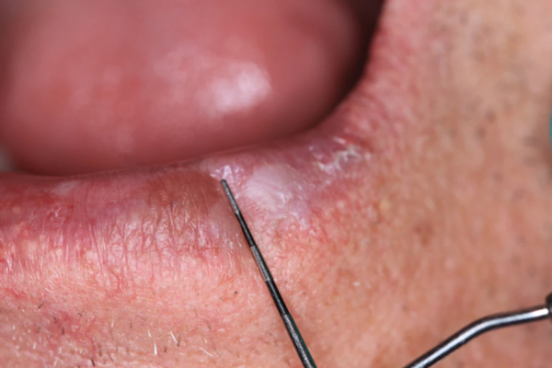 White Patches On Inner Lips | Lipstutorial.org