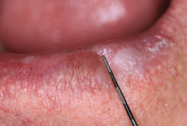 Diagnosis for BC oral pathology case No. 38: The 'harmless-looking ...