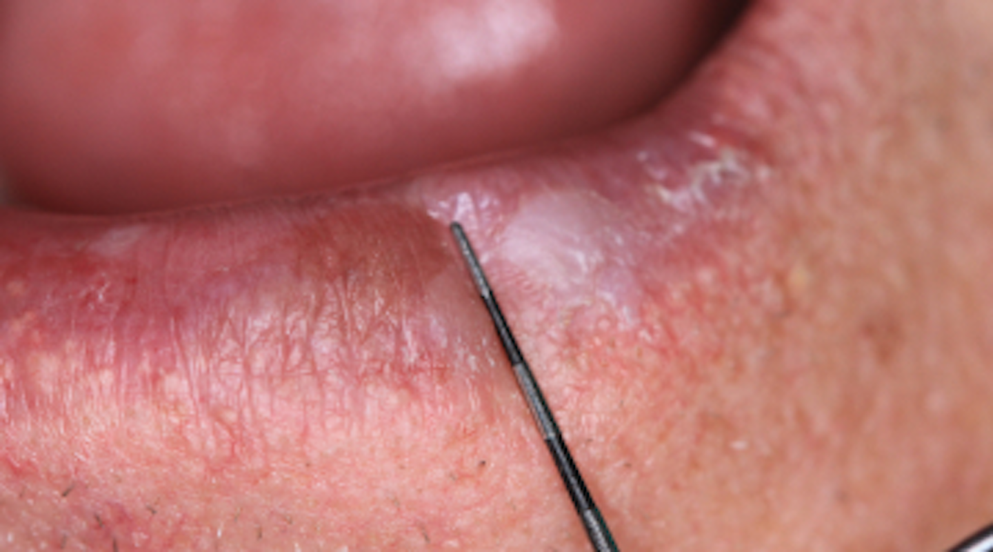 Skin Lesions On Lips