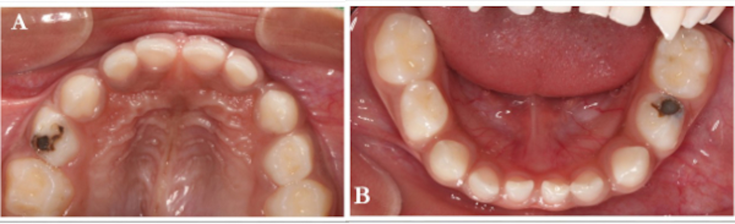 Play it SMART: Silver diamine fluoride plus ITR for dental caries ...