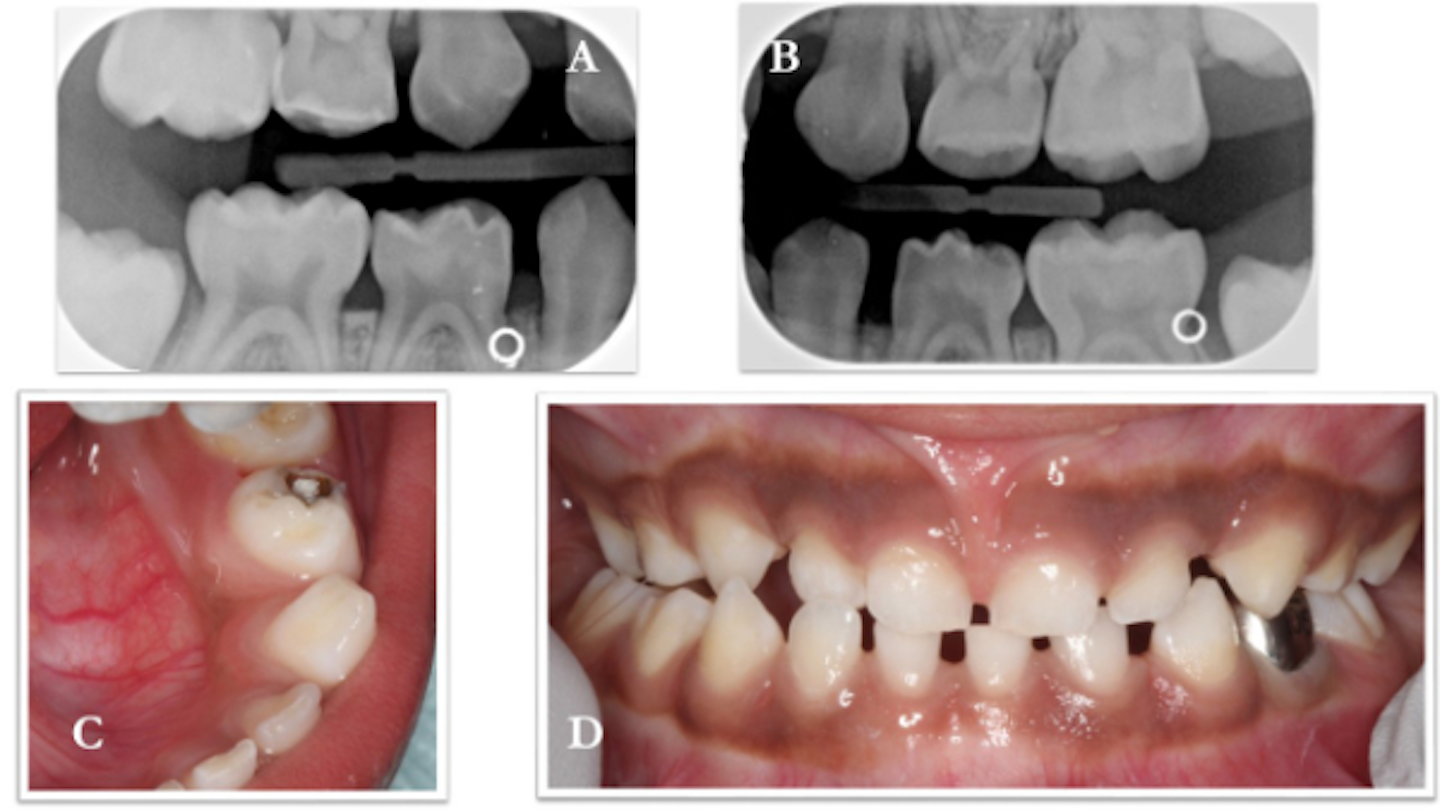 Play it SMART: Silver diamine fluoride plus ITR for dental caries ...