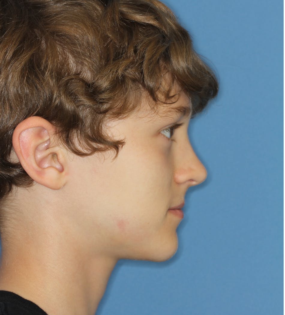 Recognizing the potential for impacted maxillary canines | Dentistry IQ