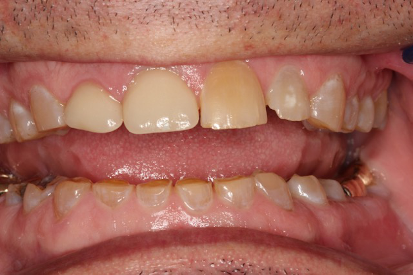 How To Confidently Address Tooth Wear Issues A Systematic Approach To