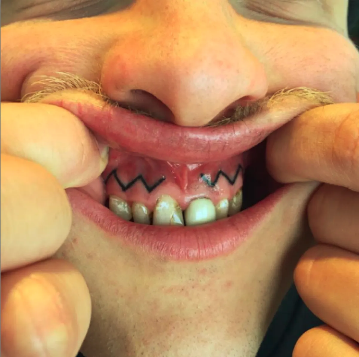 Intraoral and cosmetic tattoos: Ink about it! | Dentistry IQ