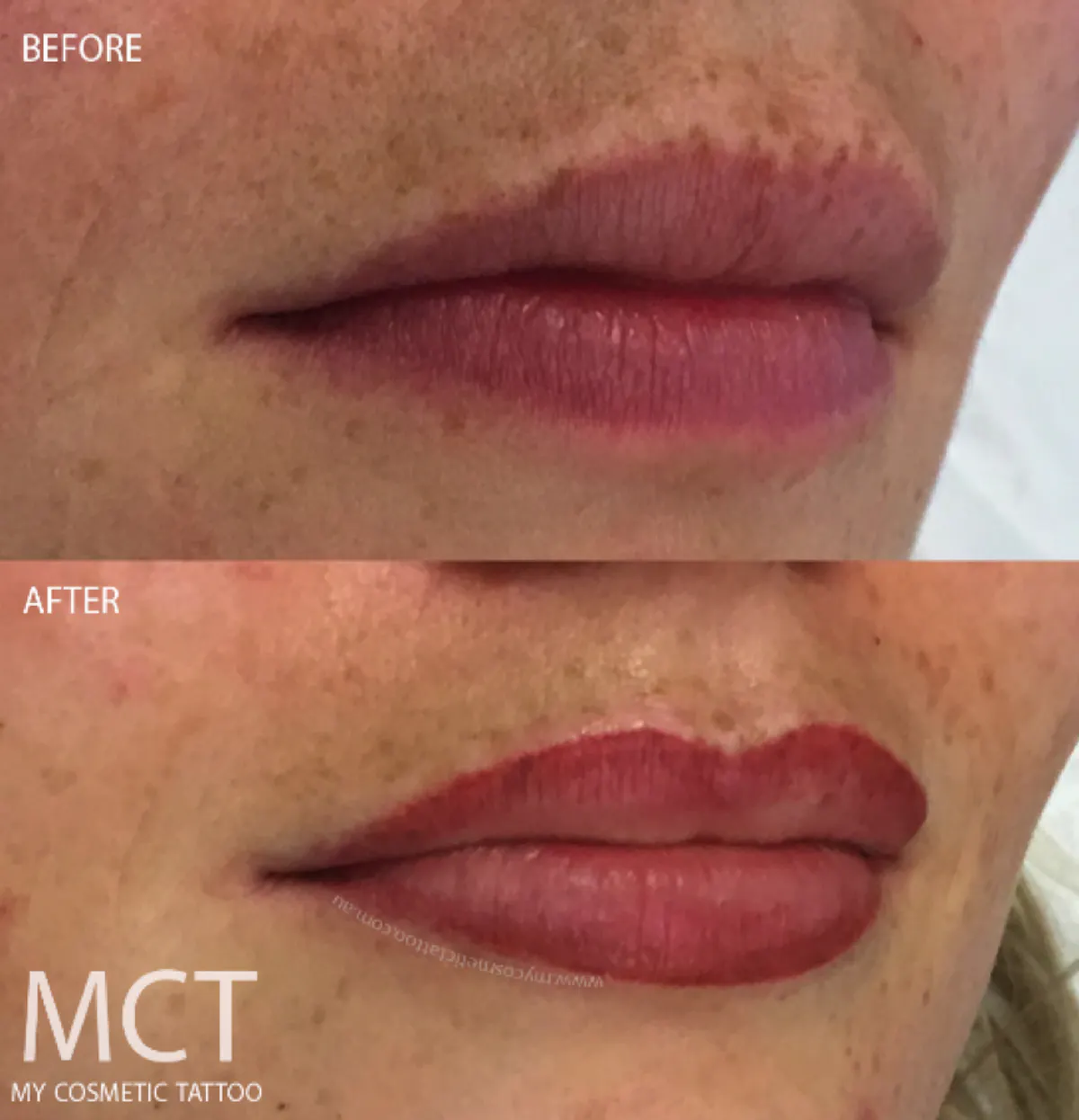 Intraoral and cosmetic tattoos: Ink about it! | Dentistry IQ