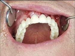 5 questions to ask before choosing between delayed and immediate dental ...