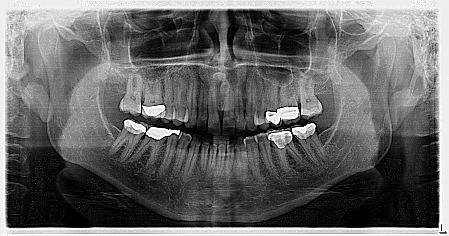 BC oral pathology case no. 48: Extra! Extra! Read all about it ...