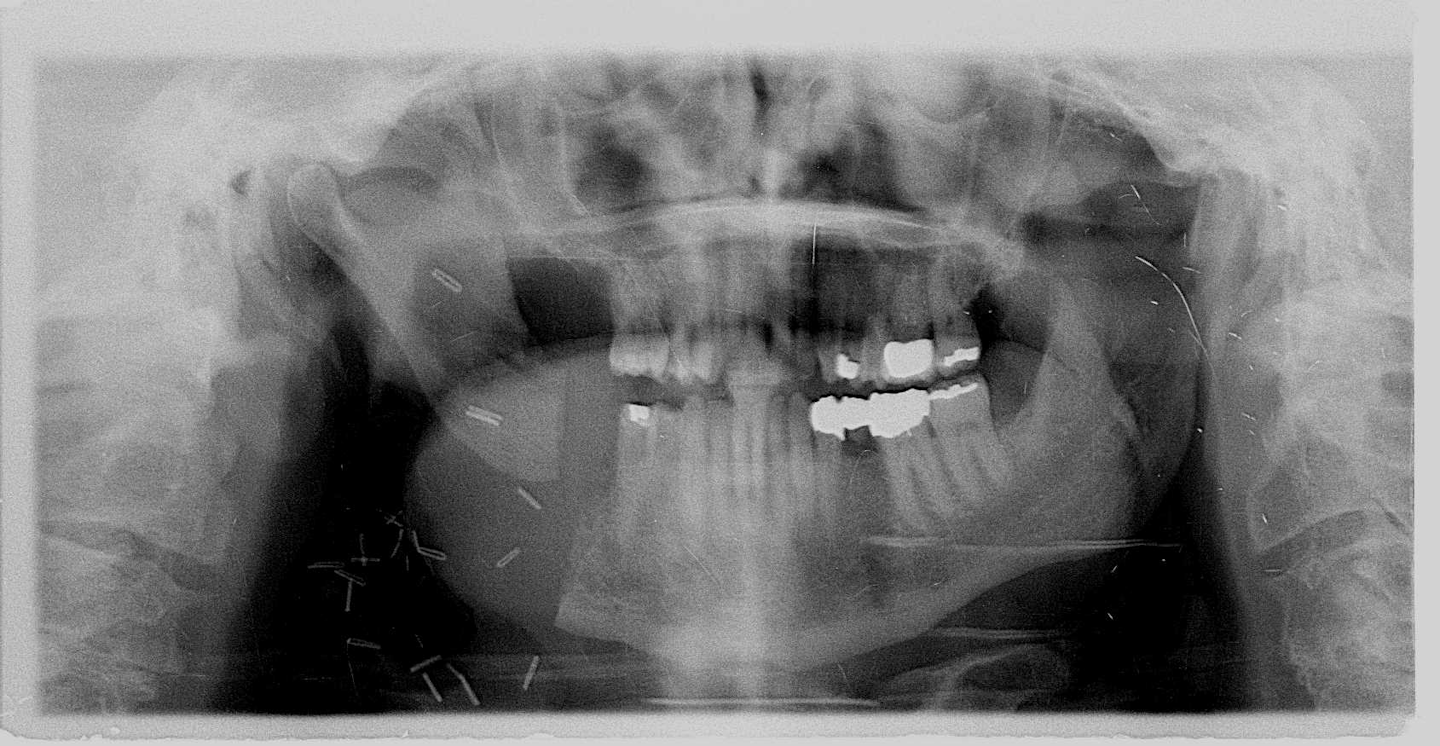 BC oral pathology case no. 49: Unfortunate outcomes for a wonderful man ...