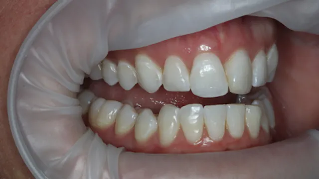 Dental product review: Skyce from Ivoclar Vivadent | Dentistry IQ