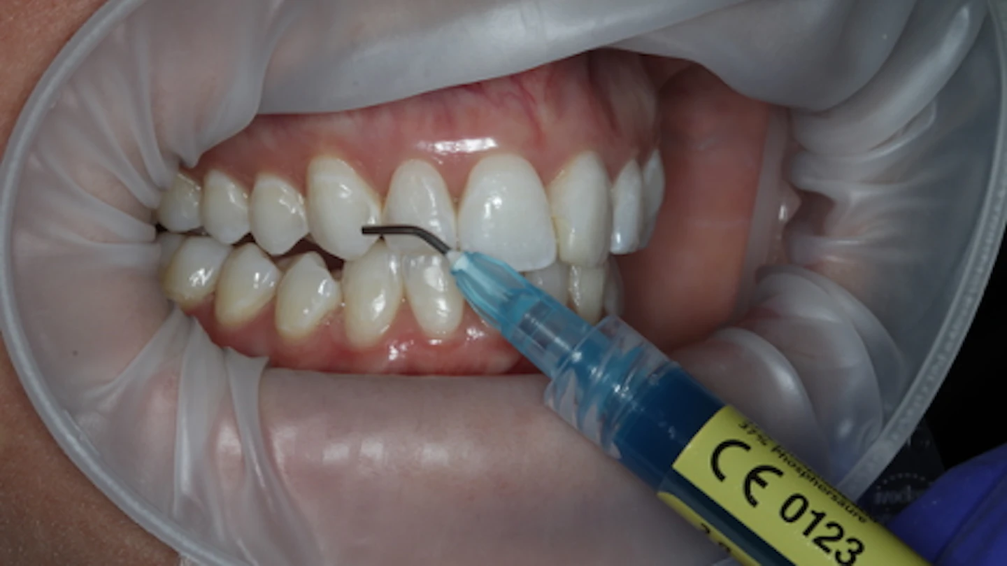 Dental product review: Skyce from Ivoclar Vivadent | DentistryIQ