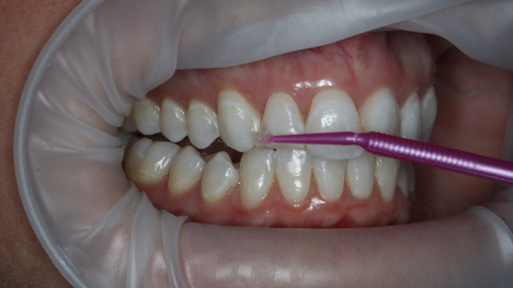 Dental product review: Skyce from Ivoclar Vivadent | Dentistry IQ