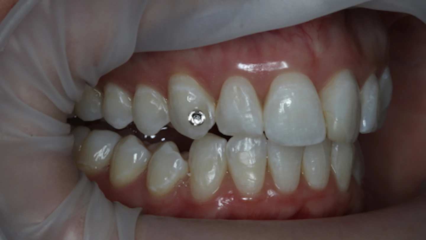 Dental product review: Skyce from Ivoclar Vivadent | DentistryIQ