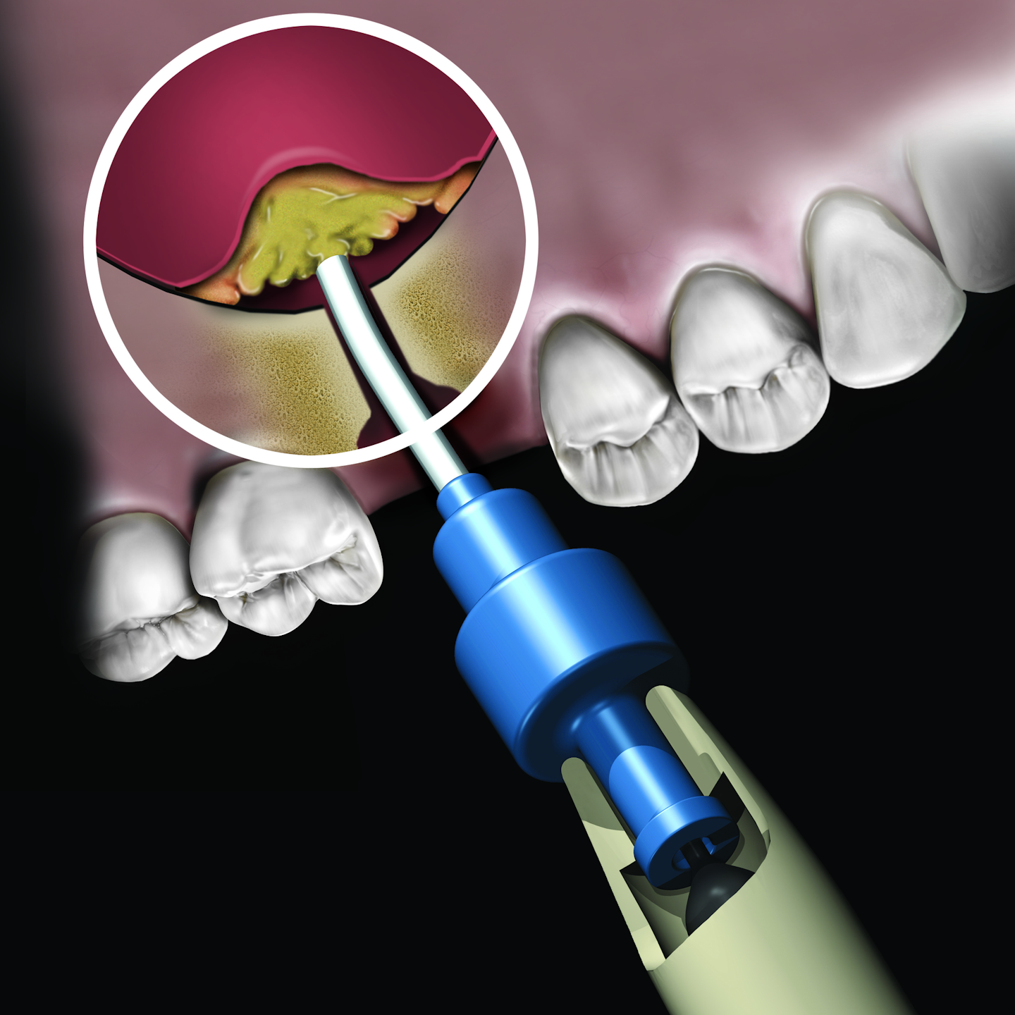 Current concepts in dental bone grafting materials | DentistryIQ