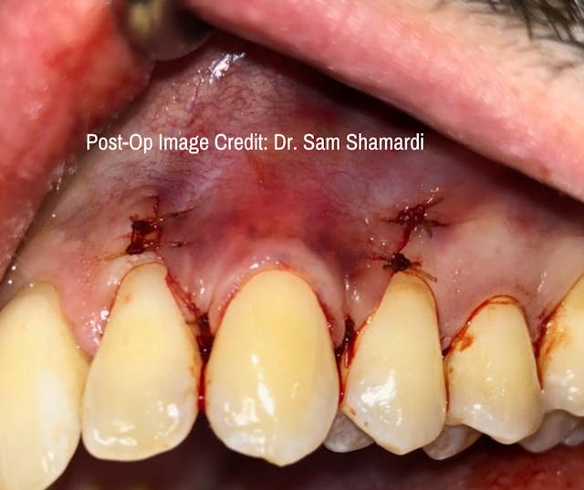 Connective tissue graft technique: Overview for dental professionals ...