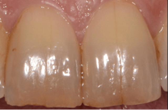 Cracked tooth: Types, causes, and treatments | Dentistry IQ