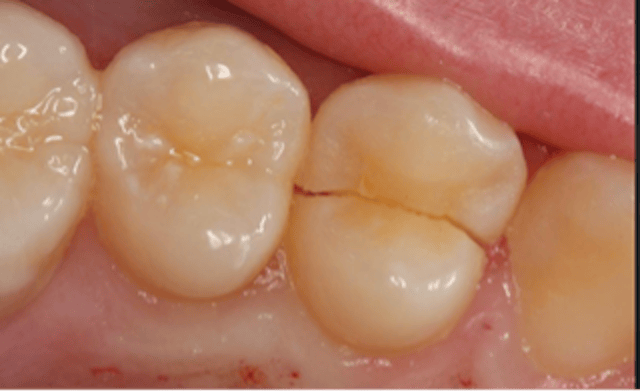 Cracked tooth: Types, causes, and treatments | Dentistry IQ
