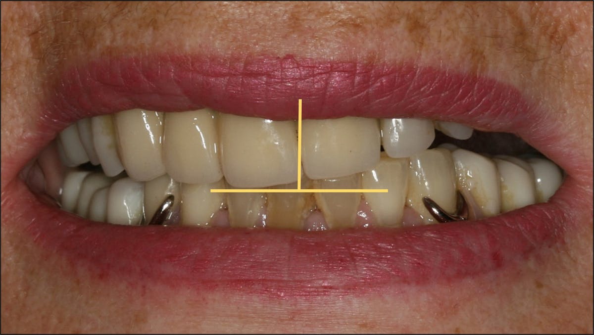 Setting up a symmetrical smile: The anterior midline critical zone ...