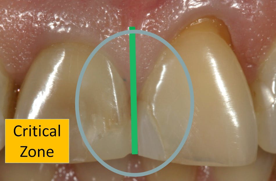 Setting up a symmetrical smile: The anterior midline critical zone ...