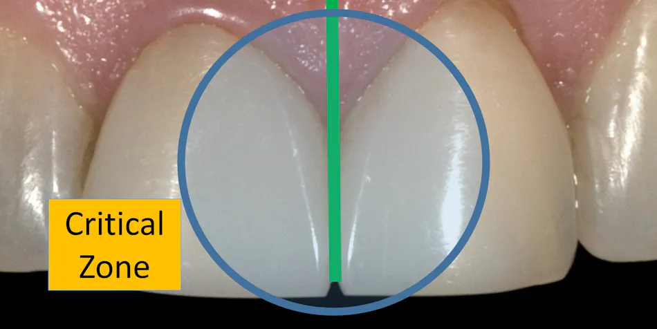 Setting up a symmetrical smile: The anterior midline critical zone ...