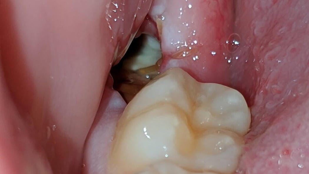 Alveolar osteitis: Etiology, prevention, and treatment | Dentistry IQ