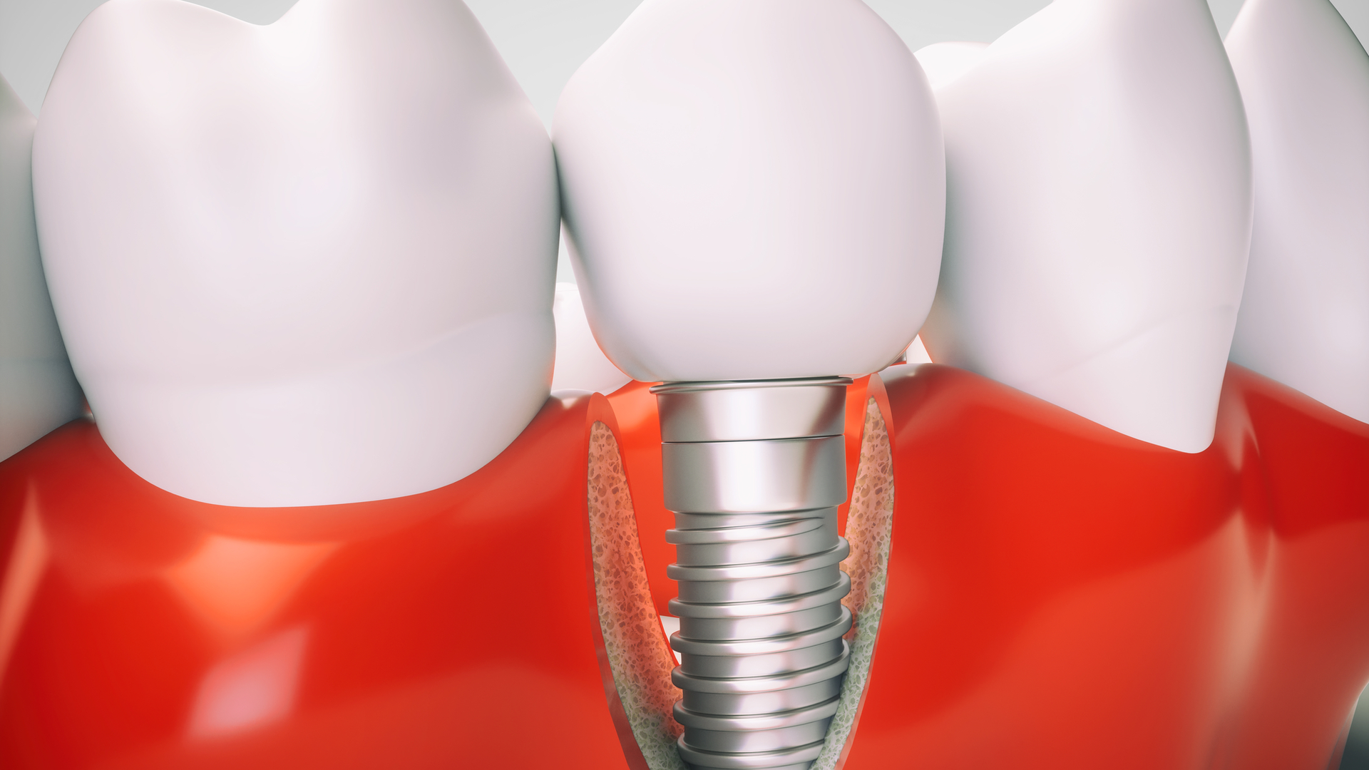 What is a dental implant? | Dentistry IQ