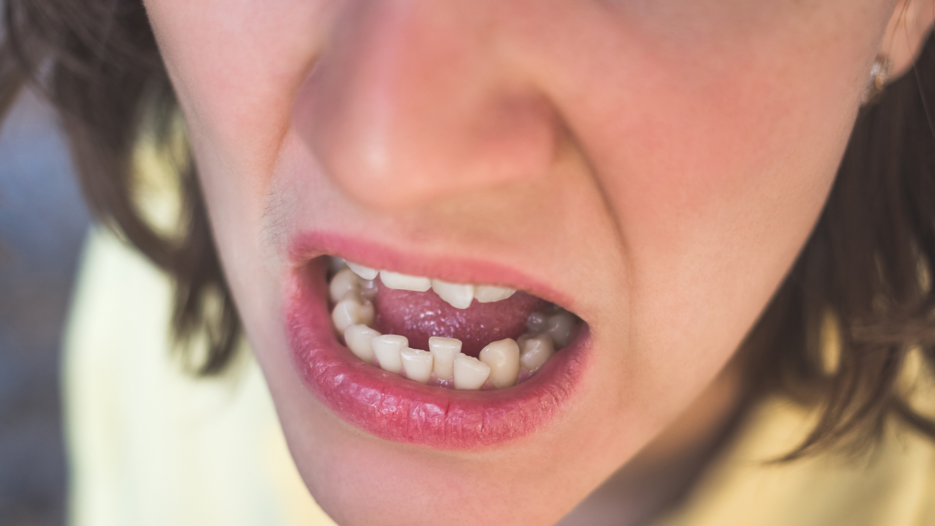 DIY teeth straightening: Please don’t try this at home! | Dentistry IQ