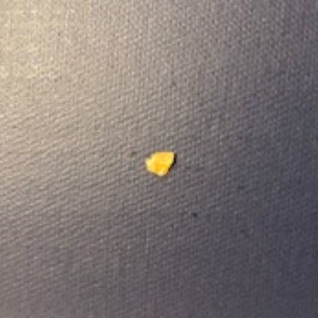 Periodontal abscess or gingival abscess? The perils of popcorn: A ...