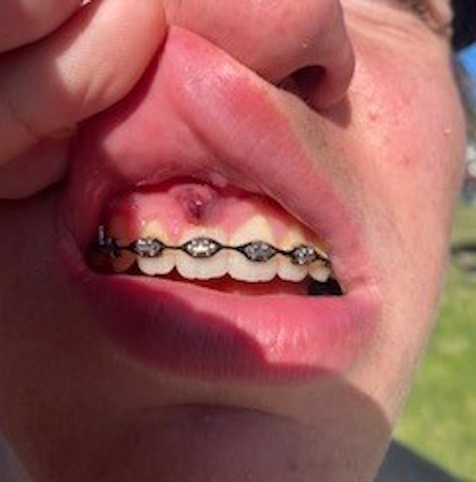 Periodontal abscess or gingival abscess? The perils of popcorn: A ...