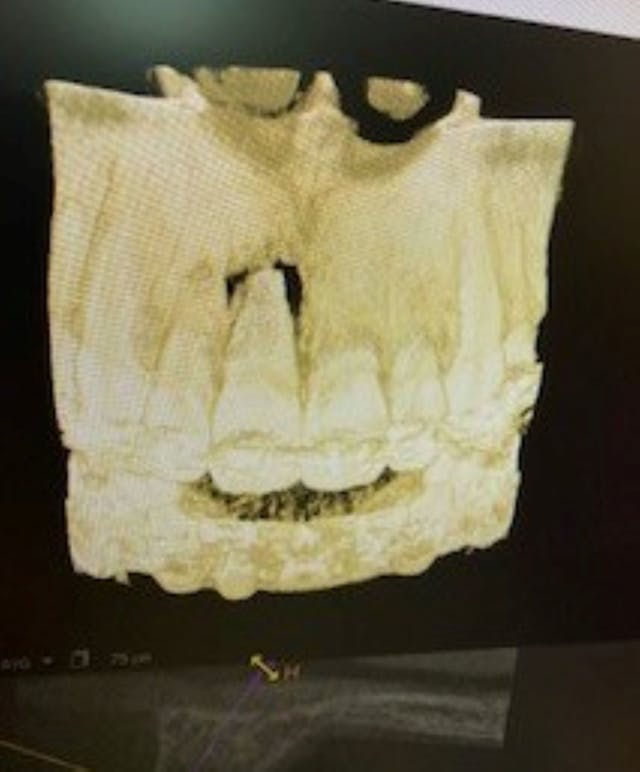 Periodontal abscess or gingival abscess? The perils of popcorn: A ...