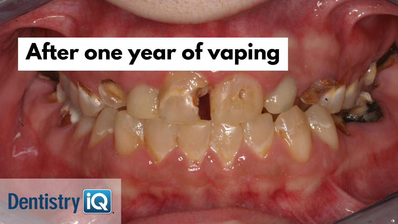 Medical History Mysteries: The vaping forecast: Cloudy with a chance of ...